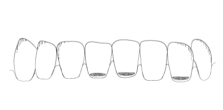 Tooth Abrasion – Winona Dental